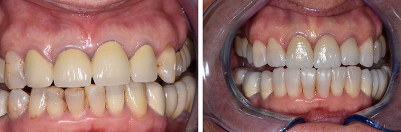 Prosthetics for Patients With Missing Front Teeth